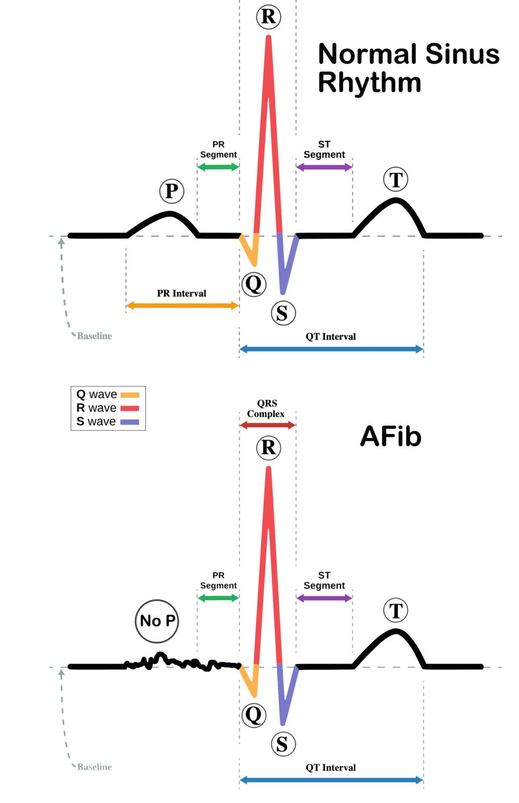 What is Atrial Fibrillation (AFib)? | Surrey Cardiovascular Clinic
