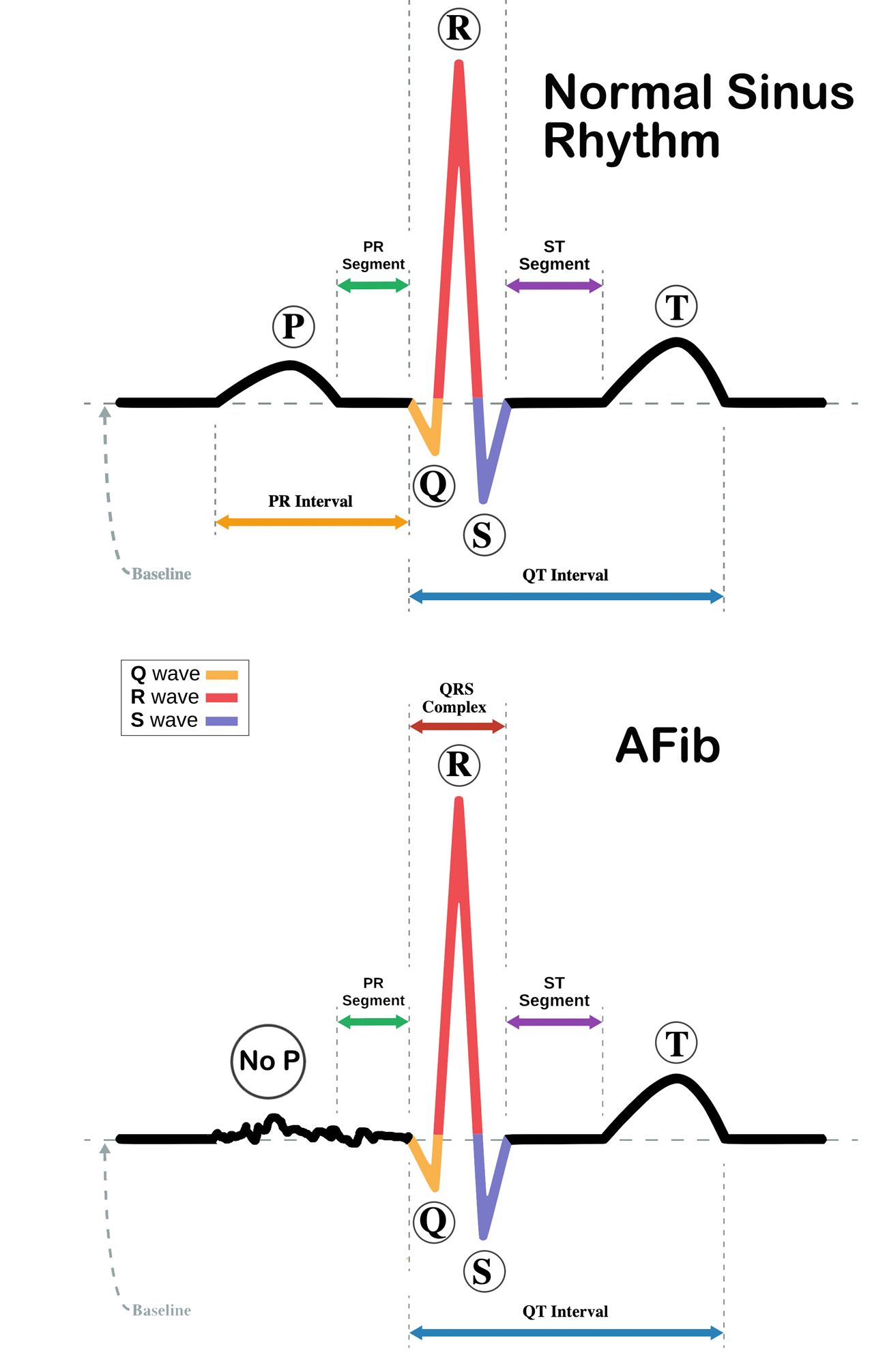 What is Atrial Fibrillation (AFib)? | Surrey Cardiovascular Clinic