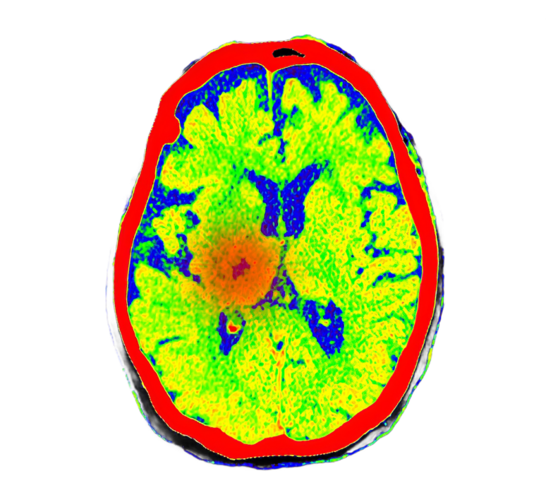 How AFib can present as a heart attack or stroke | Surrey ...