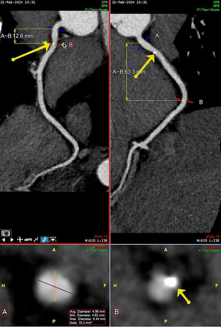 Why I now might want to calcify my coronary arteries! | Surrey ...