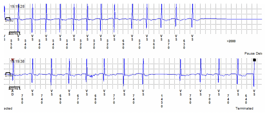 Bradycardia: When a Slow Heart Rate Becomes a Health Concern? | Surrey ...