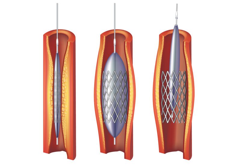 10 Things Everyone Who Has Had a Coronary Stent or Bypass Operation ...