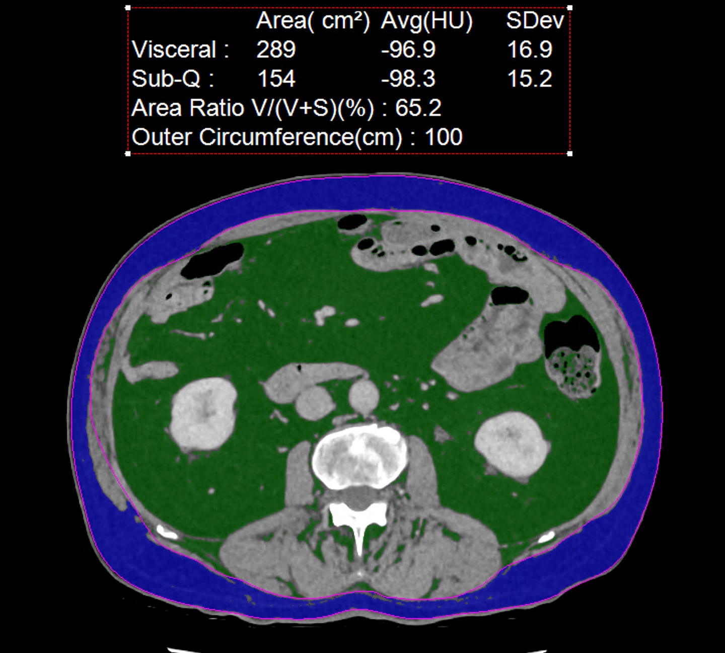 How to Lose Visceral Adipose Tissue (VAT) and Improve Metabolic Health ...