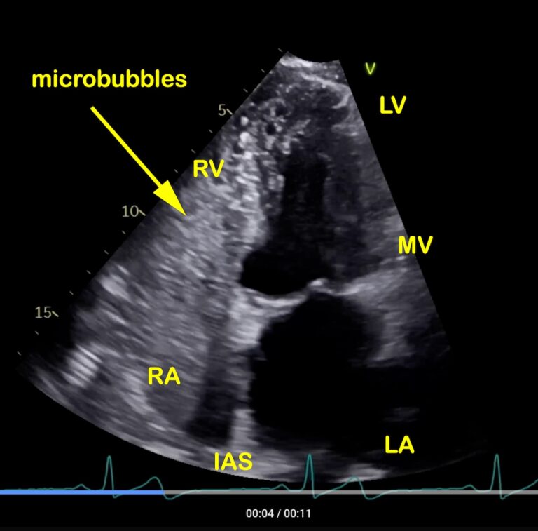Patent Foramen Ovale (PFO): A Hidden Link in Stroke, TIA, Migraine and ...